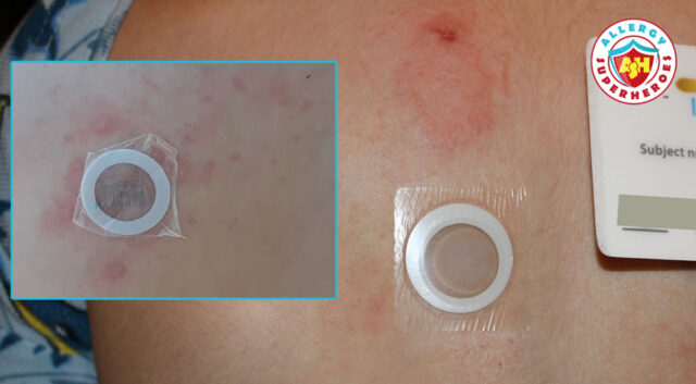 Disappointment with the DBV Peanut Patch - Allergy Superheroes Blog